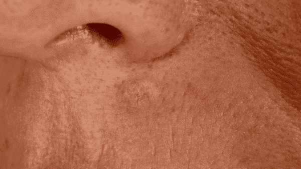 Bilder av hudcancer | Hur ser det ut? | Hudcancerkliniken