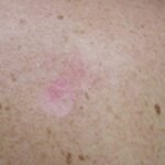 Bilder av hudcancer | Hur ser det ut? | Hudcancerkliniken